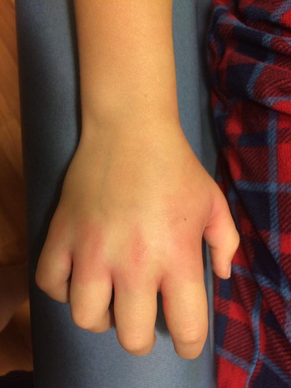 What does a red line from a bee sting look like? - Oregon Outdoor Family