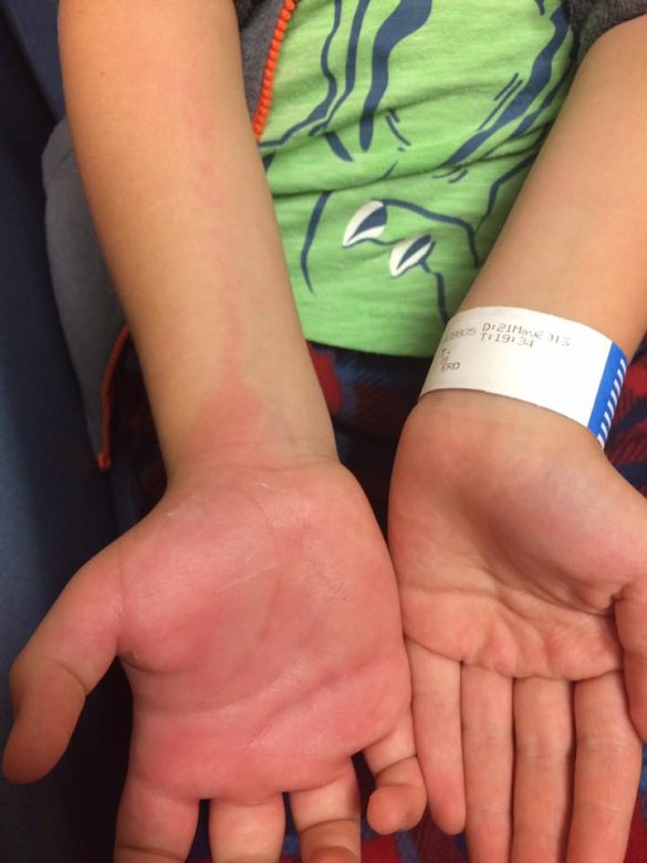 What does a red line from a bee sting look like? - Oregon Outdoor Family