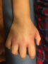 What does a red line from a bee sting look like? - Oregon Outdoor Family